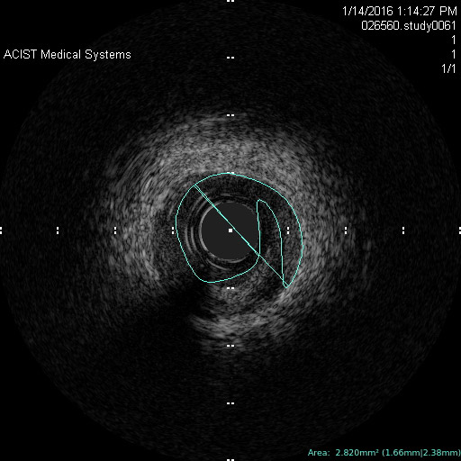 Post-PCI HD IVUS Edge Dissection in LAD | ACIST HDi Case Study | ACIST ...